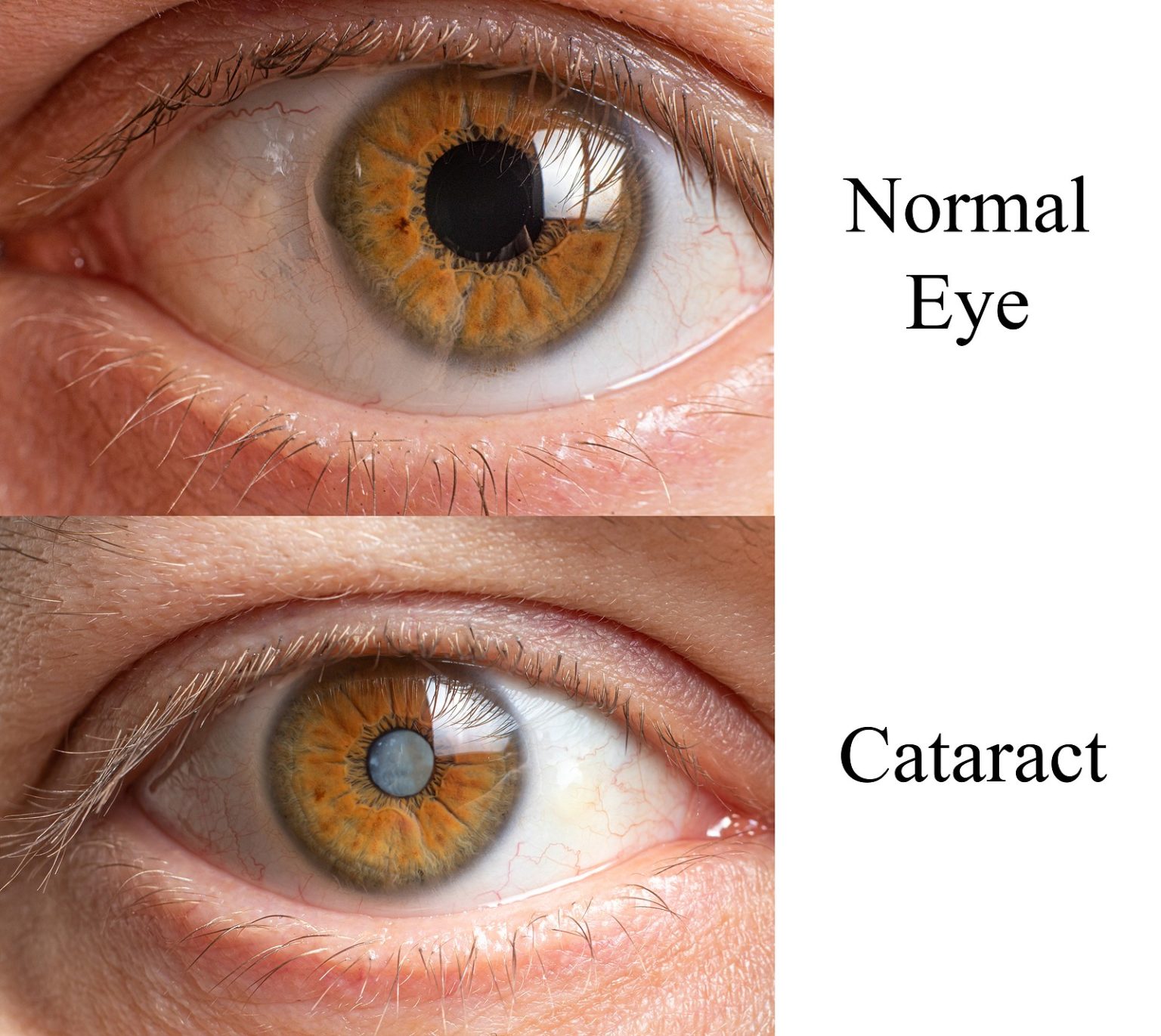 10 Common Questions About Cataracts - KE - Eye Centers of Texas