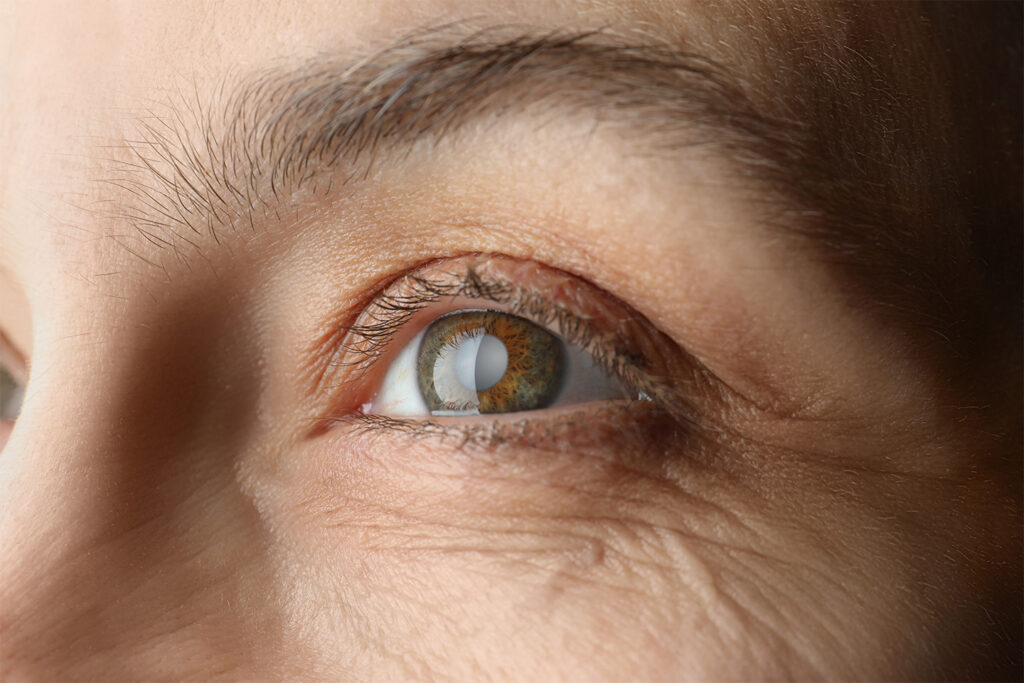What Are the Stages of Cataracts? Understanding Progression